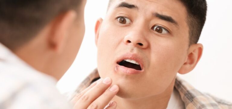 Stomatitis: What Is It, Causes, Signs, And More - Bionaze.com